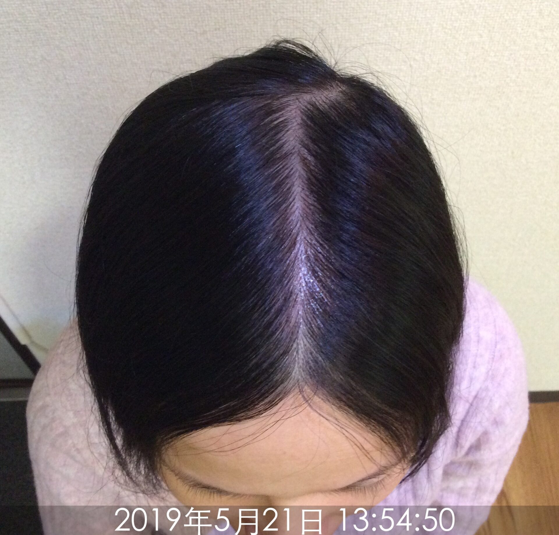 【女性の薄毛】びまん性脱毛症の特徴②